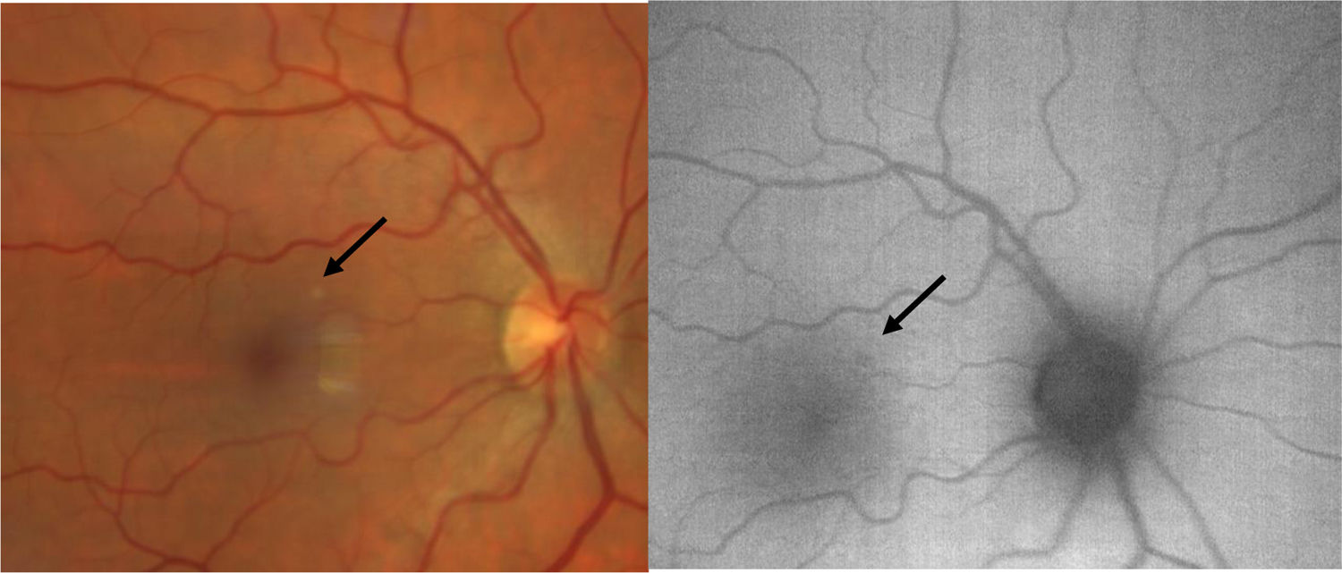 Acute macular neuroretinopathy associated with dengue virus infection ...