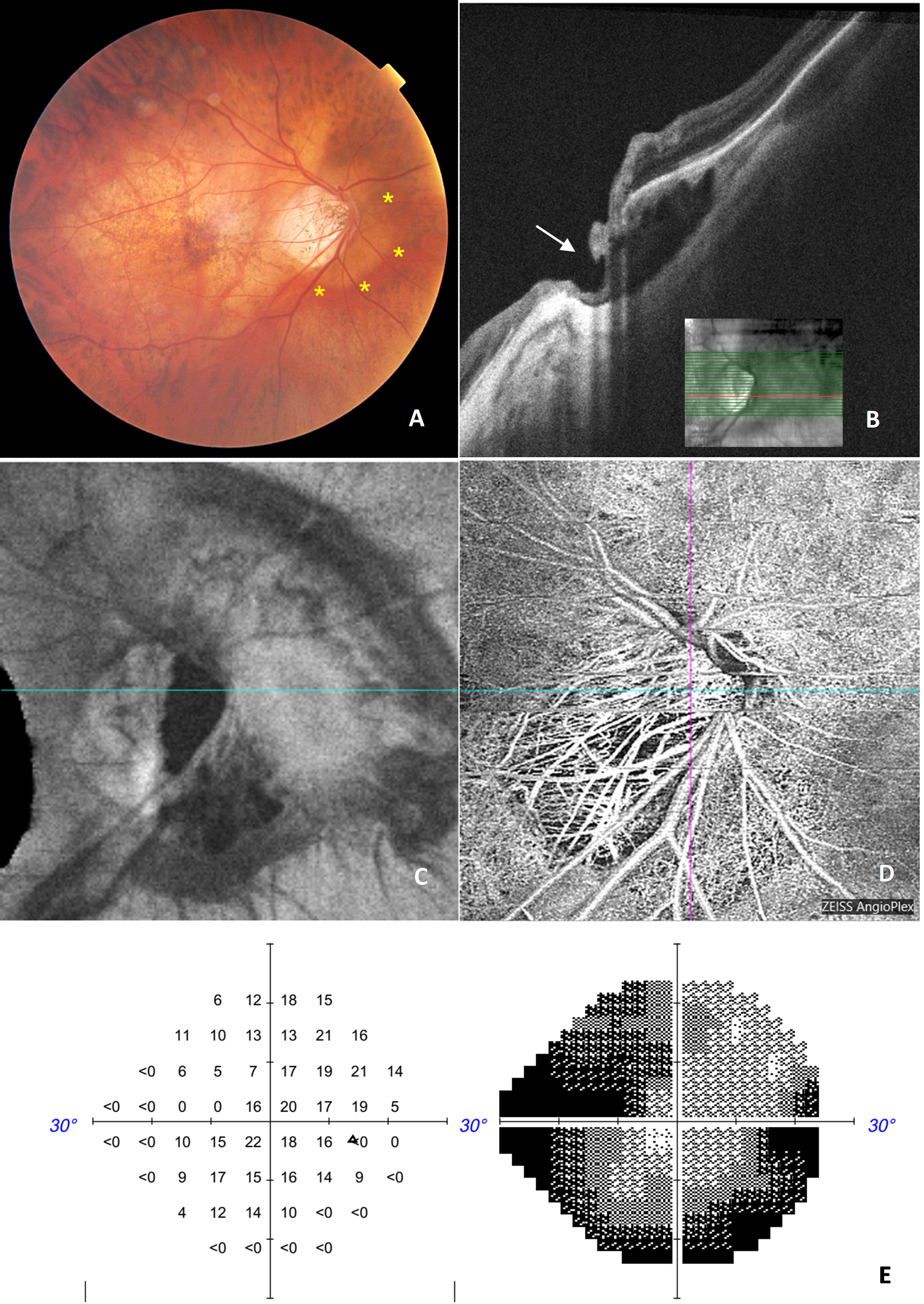 Peripapillary intrachoroidal cavitation | Archivos de la Sociedad ...