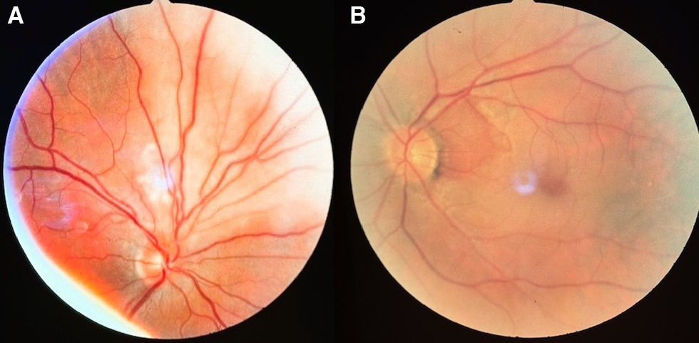 Bilateral and simultaneous retinal artery occlusion in a woman with ...