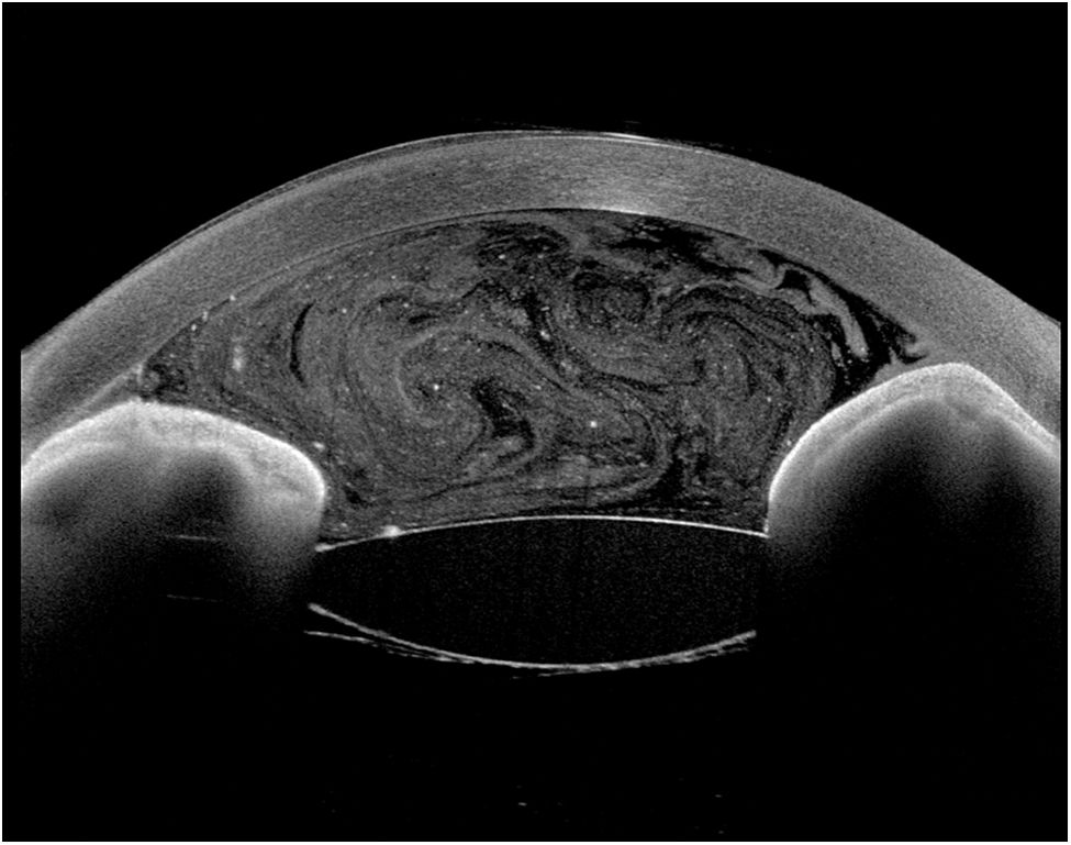 The starry night: Pigment turbulence after peripheral iridotomy in iris ...