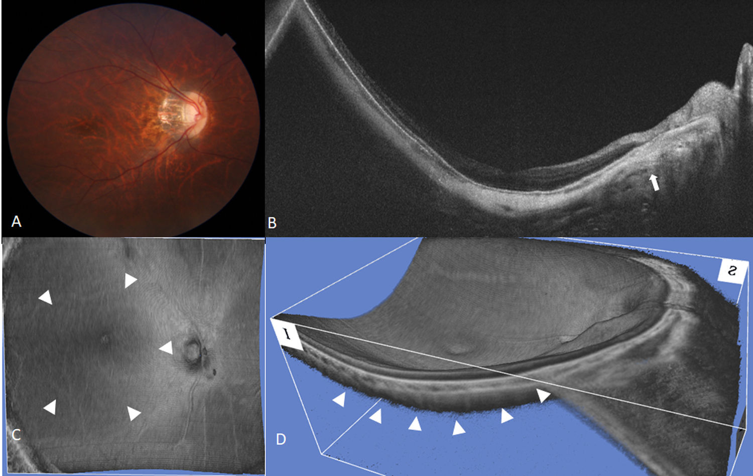 Classification of posterior staphyloma in pathologic myopia using 3D ...