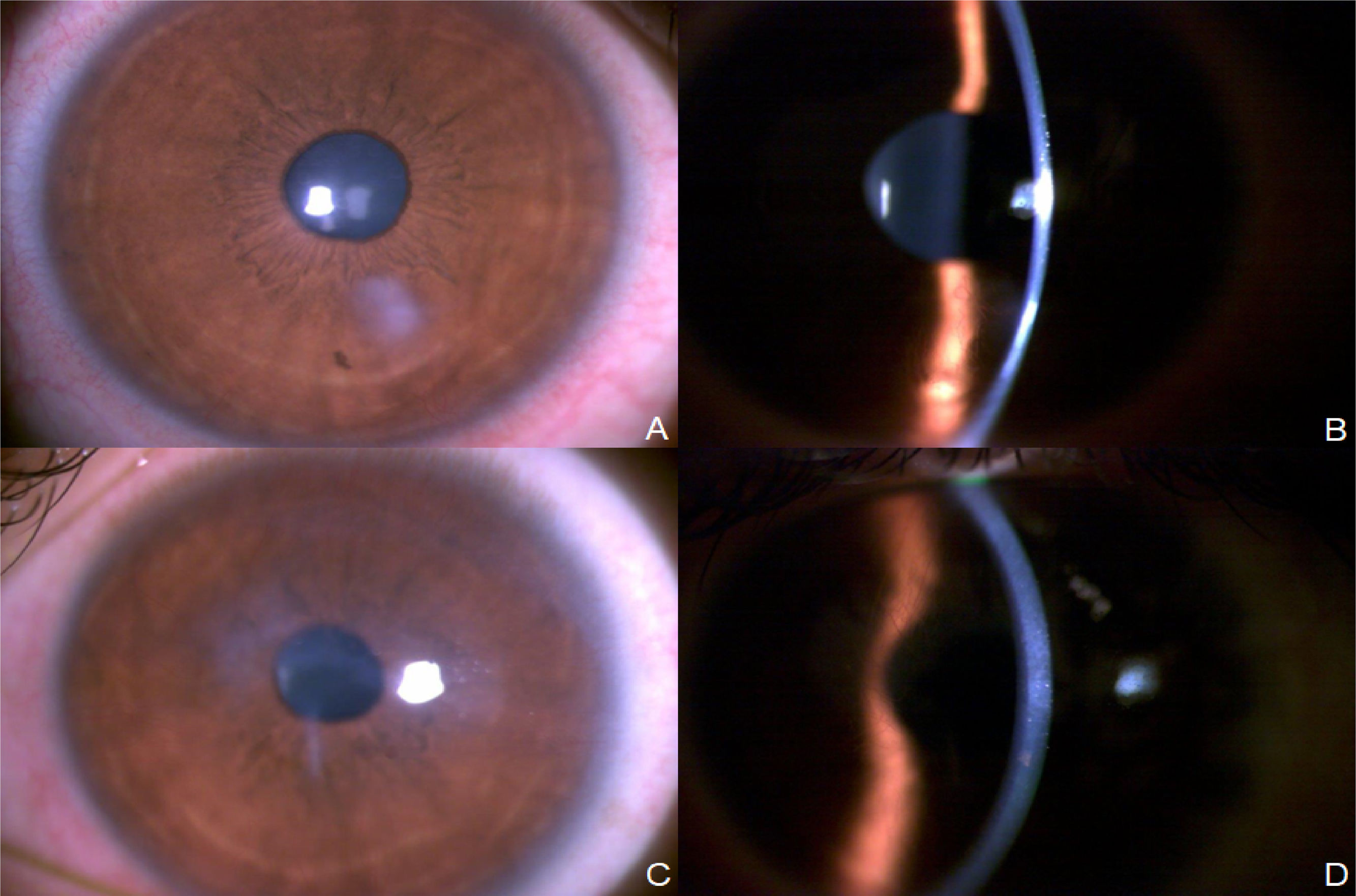 Bilateral corneal ulcer due to K. oxytoca: A case report | Archivos de ...