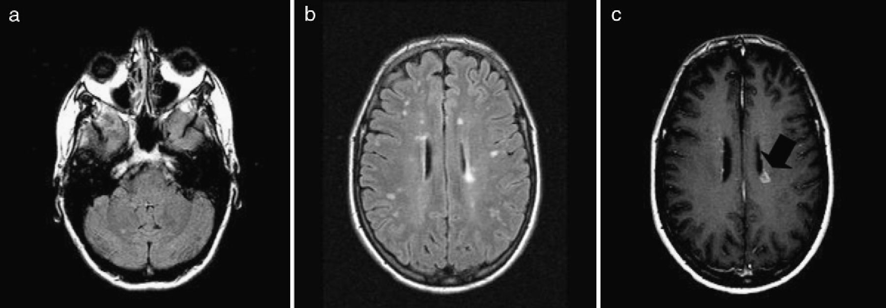 Unilateral eyelid myokymia as a form of presentation of multiple ...