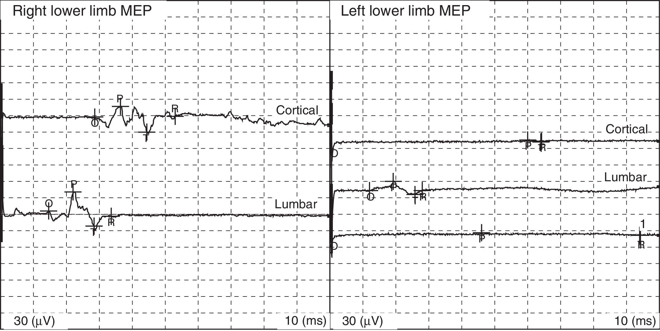 Recommendations for the clinical use of motor evoked potentials in ...
