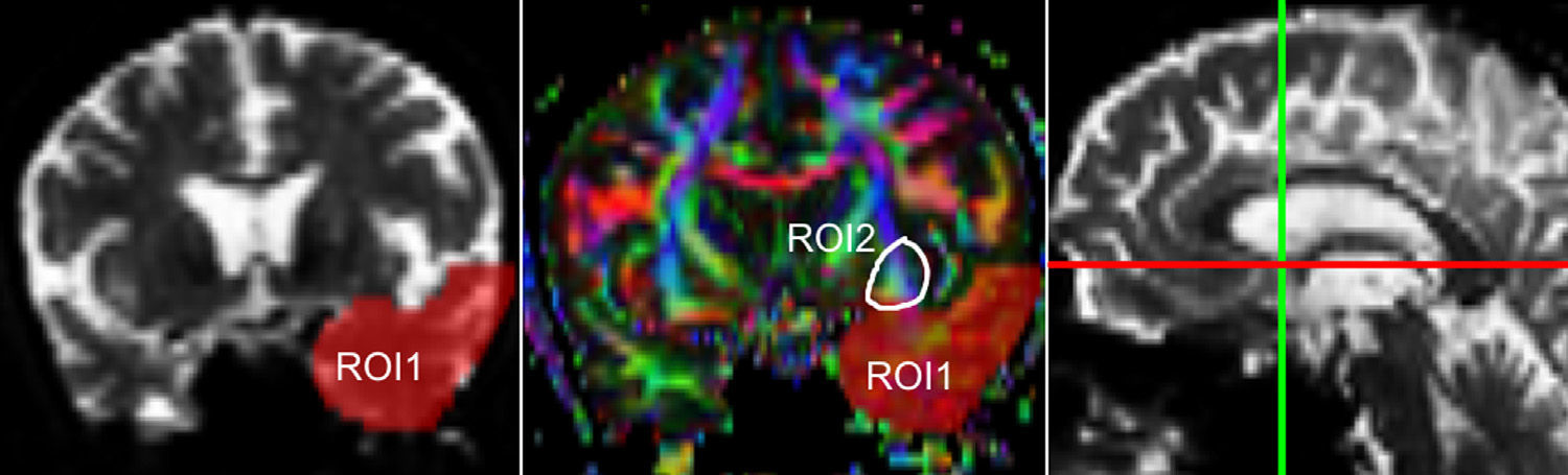 Tractography of the uncinate fasciculus and the posterior cingulate ...