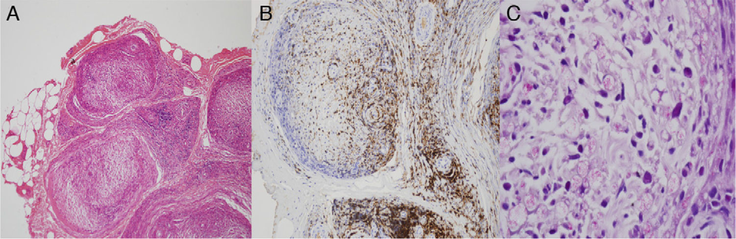 paraneoplastic mononeuritis multiplex