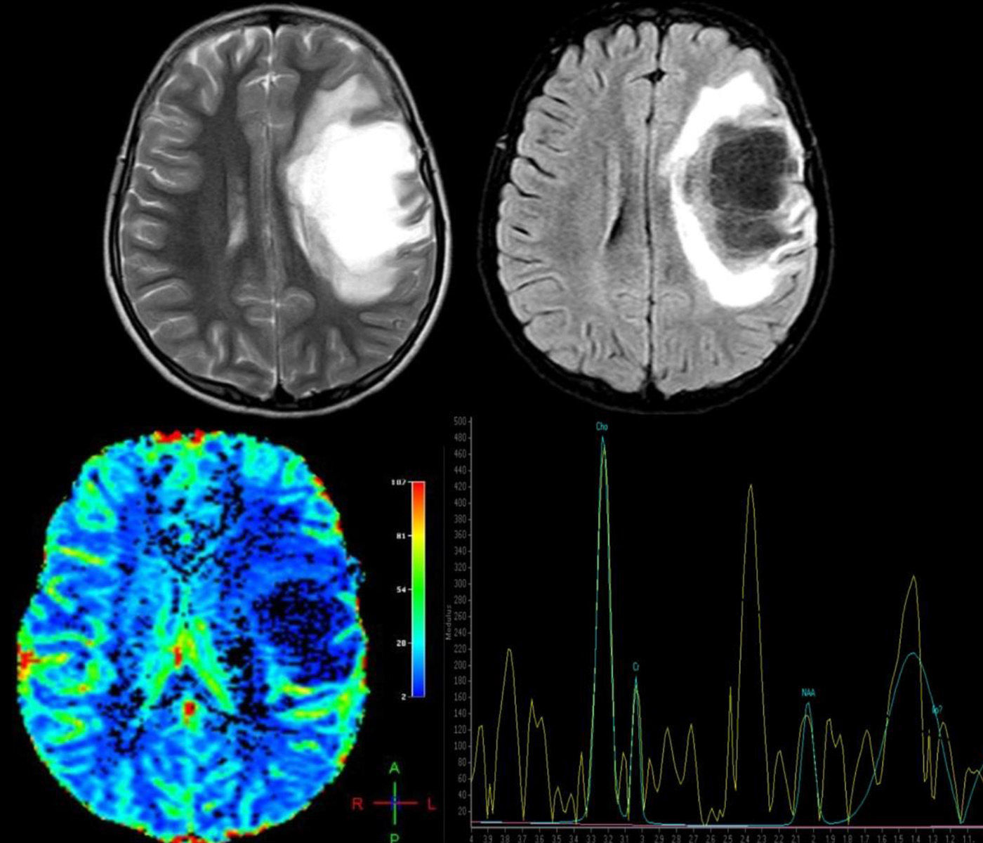 demyelination mri sequences