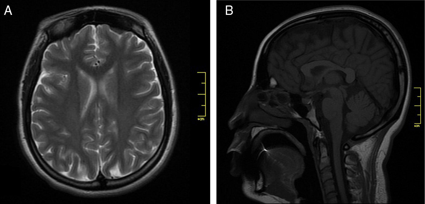 Diaphragmatic flutter: A case report and literature review | Neurología ...