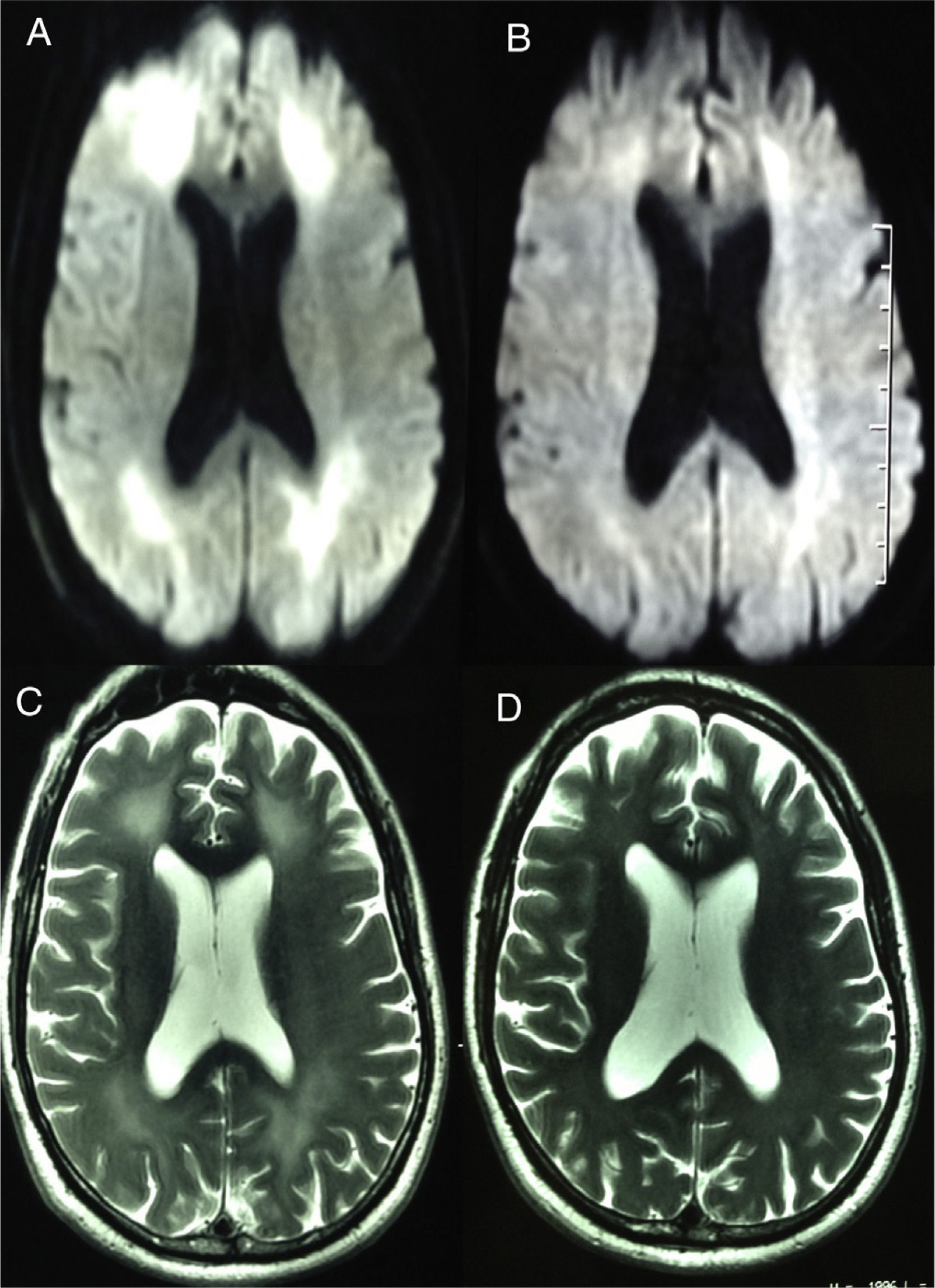 Delayed-onset encephalopathy caused by carbon monoxide poisoning ...