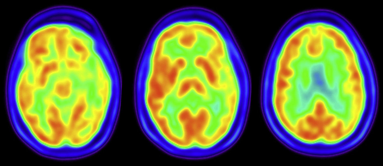 logopenic ppa diagnosis