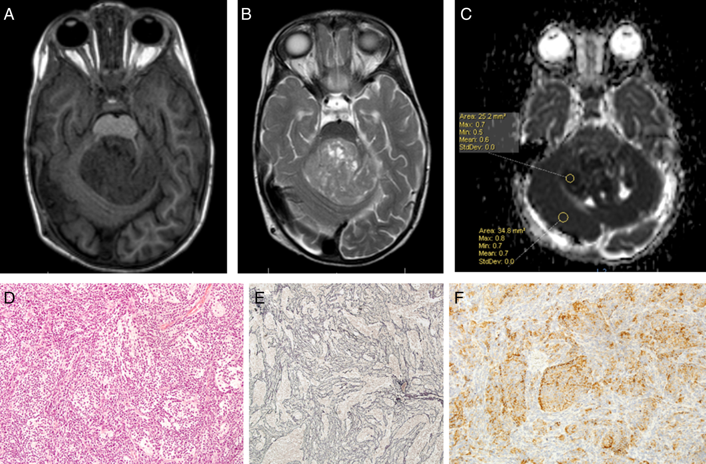 Evaluating the apparent diffusion coefficient in MRI studies as a means ...
