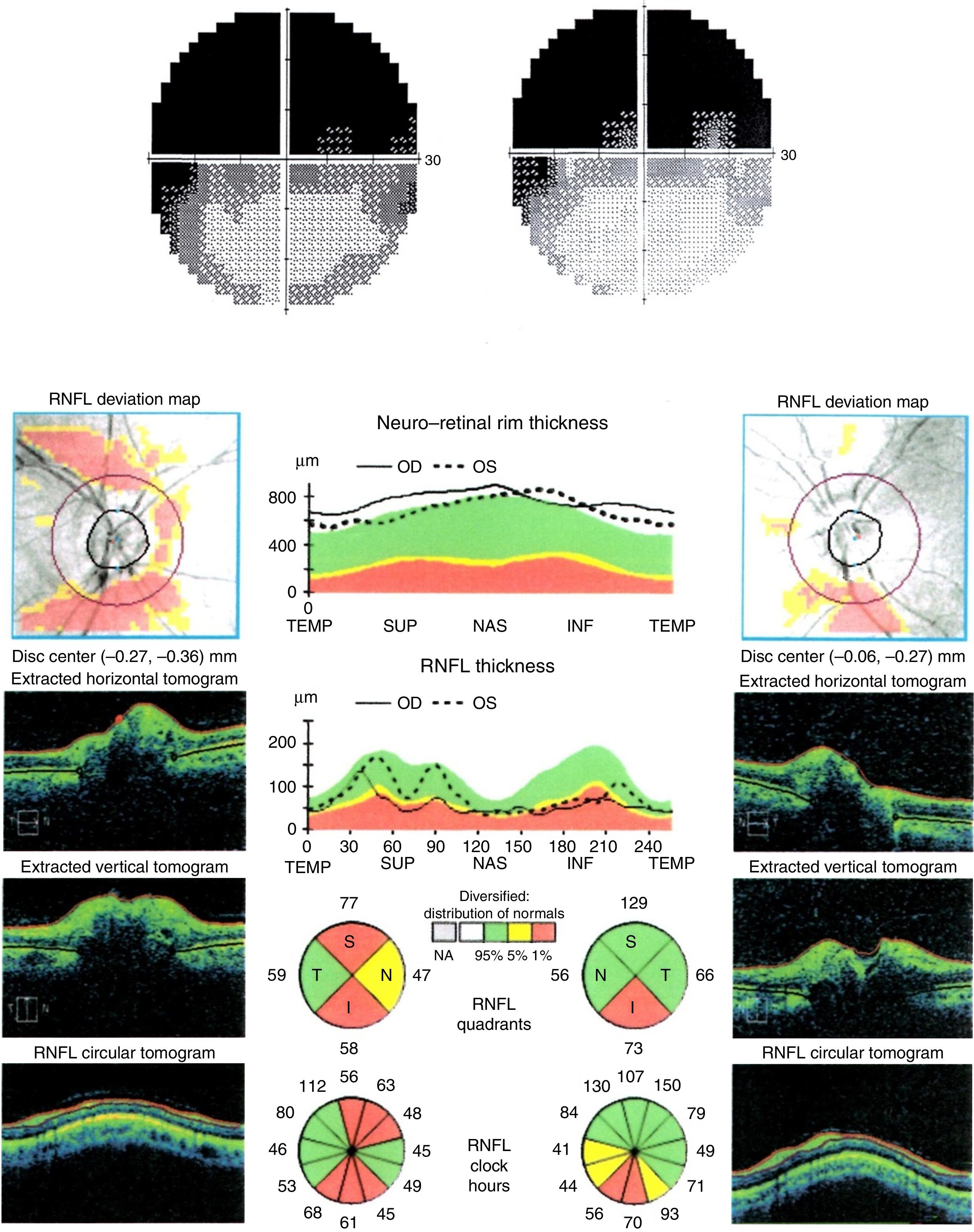 drusen oct optic nerve