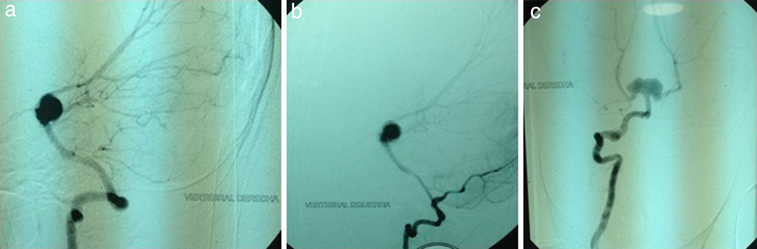Multiple vascular malformations in a patient with microcephalic ...