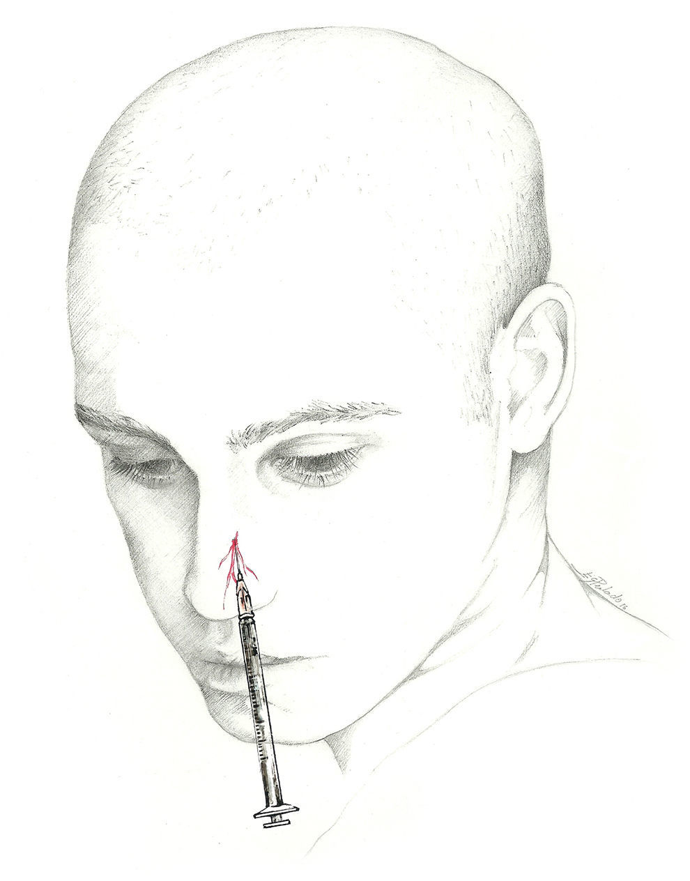 nasociliary nerve block