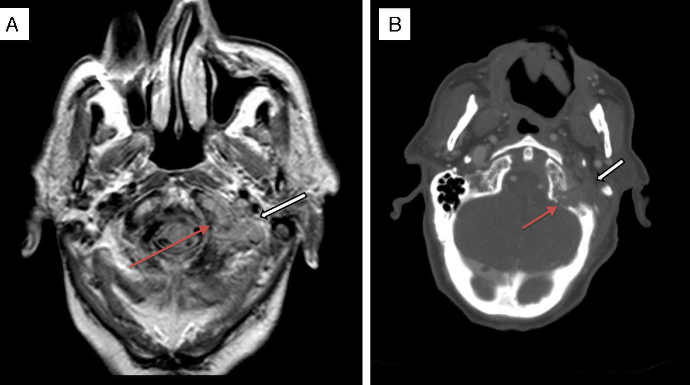 Collet–Sicard syndrome caused by metastasis | Neurología (English Edition)