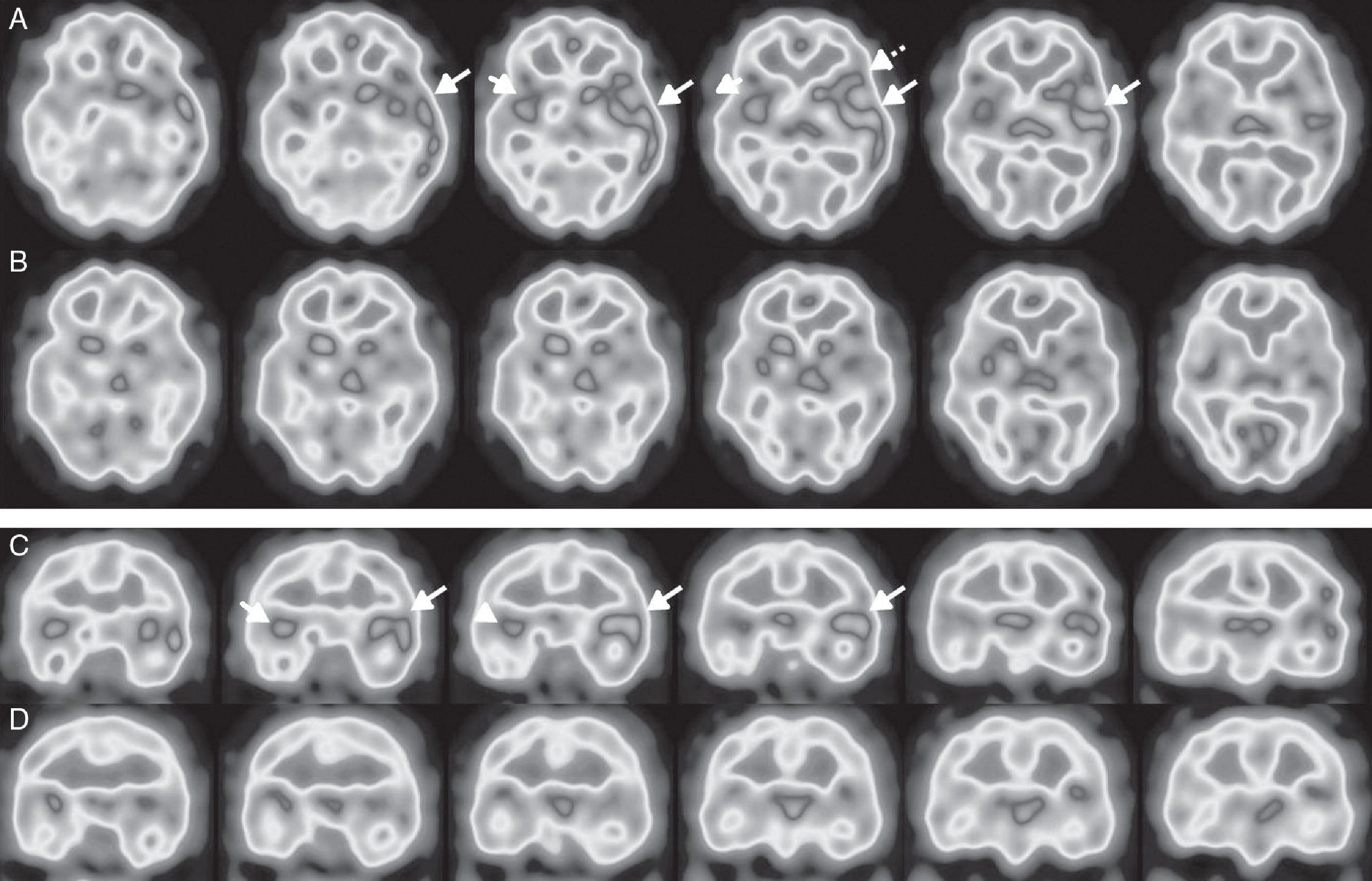 Brain perfusion SPECT with 99mTc-HMPAO in the diagnosis and follow-up ...
