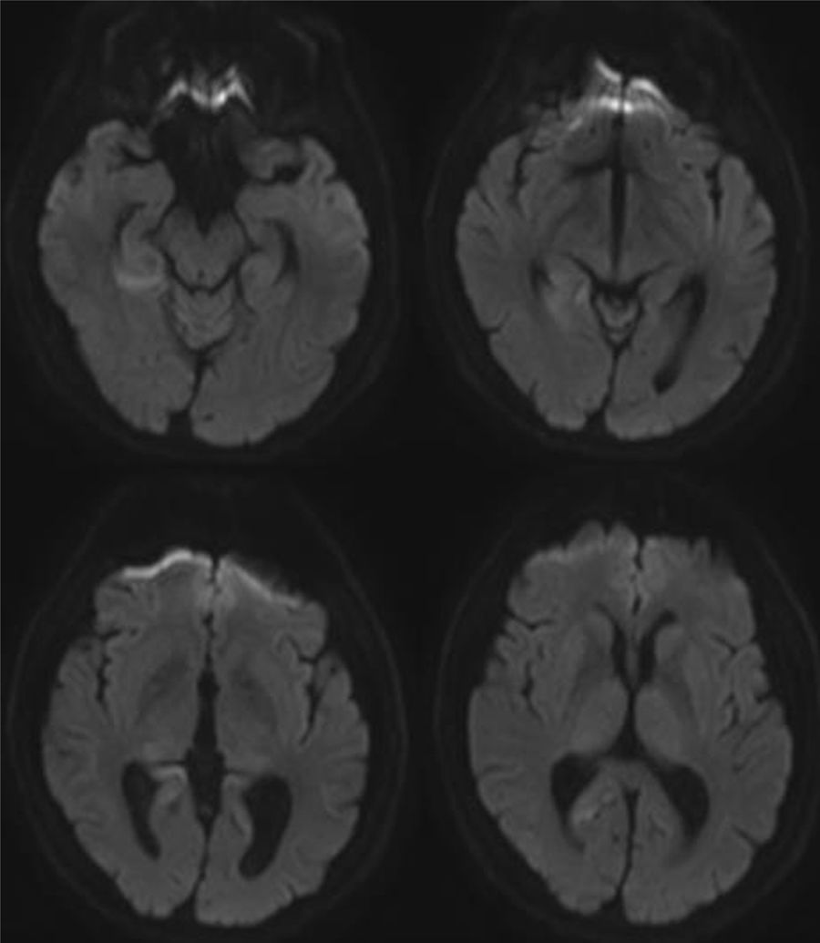 Muscle atrophy and fasciculations as a manifestation of sporadic ...