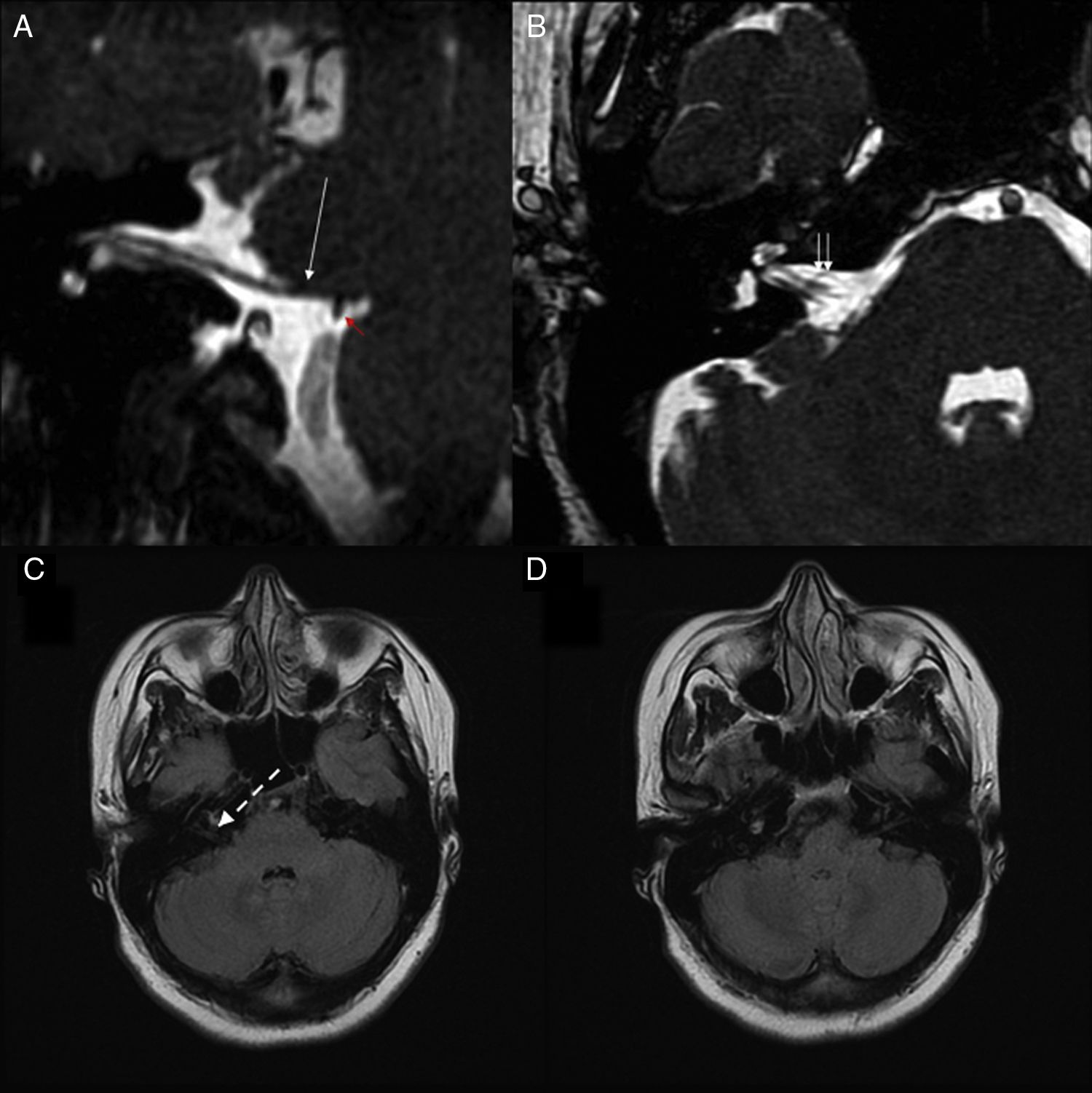 Hemifacial spasm and vestibular paroxysmia: co-presence of two ...