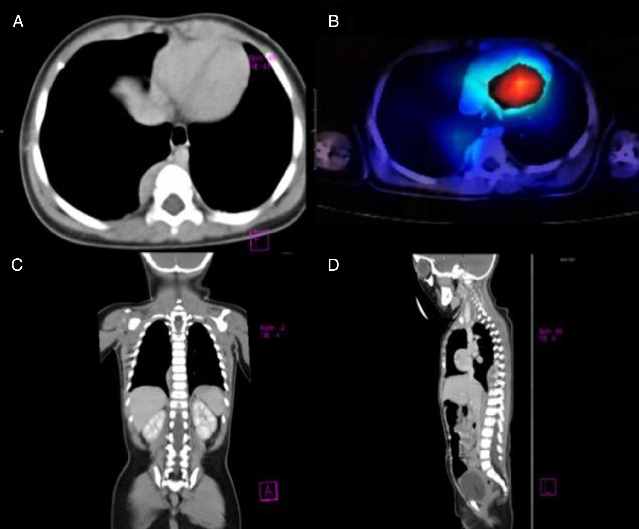 Immunosuppressive therapy in opsoclonus-myoclonus-ataxia syndrome ...