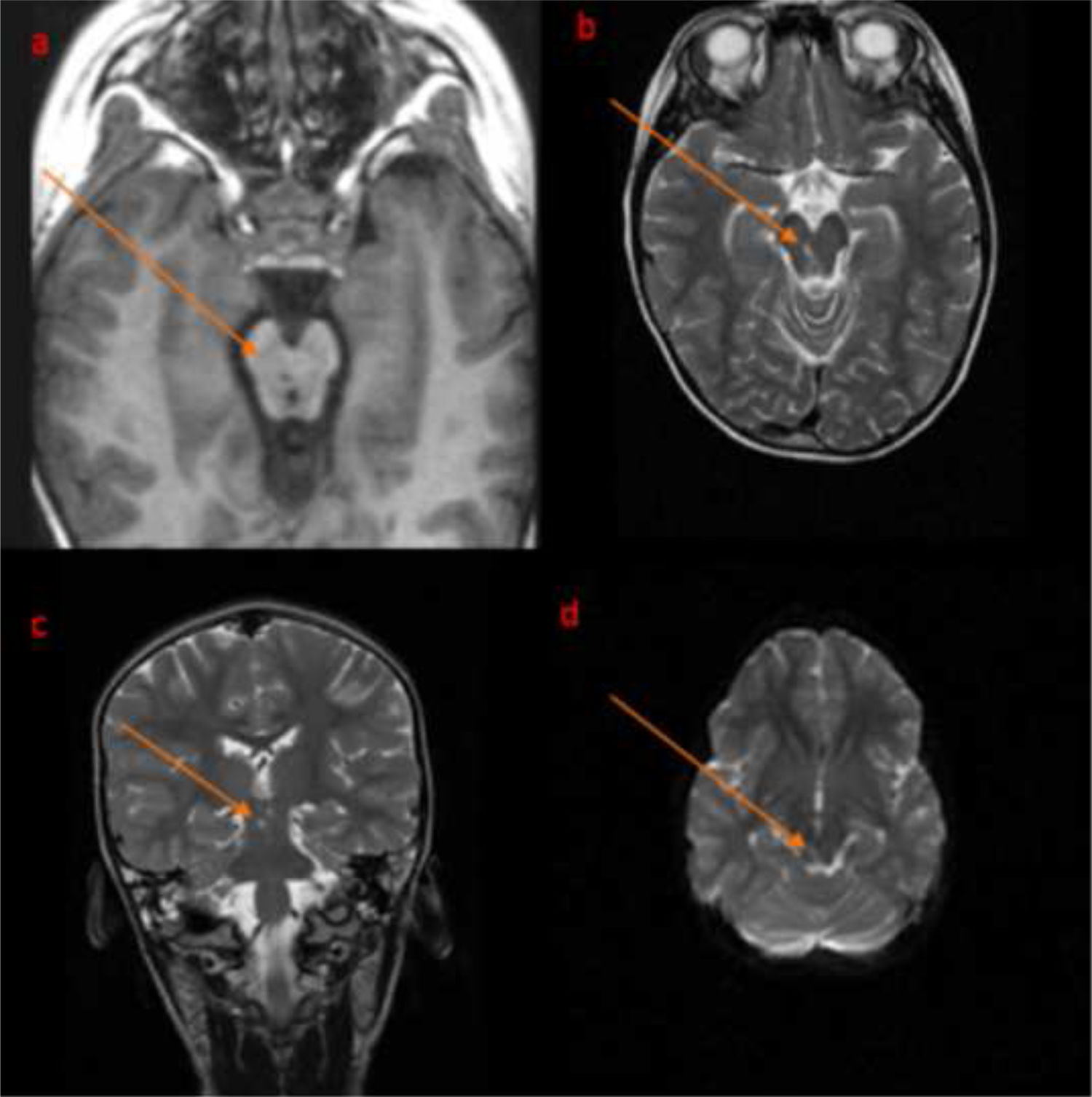 Claude syndrome secondary to head trauma | Neurología (English Edition)
