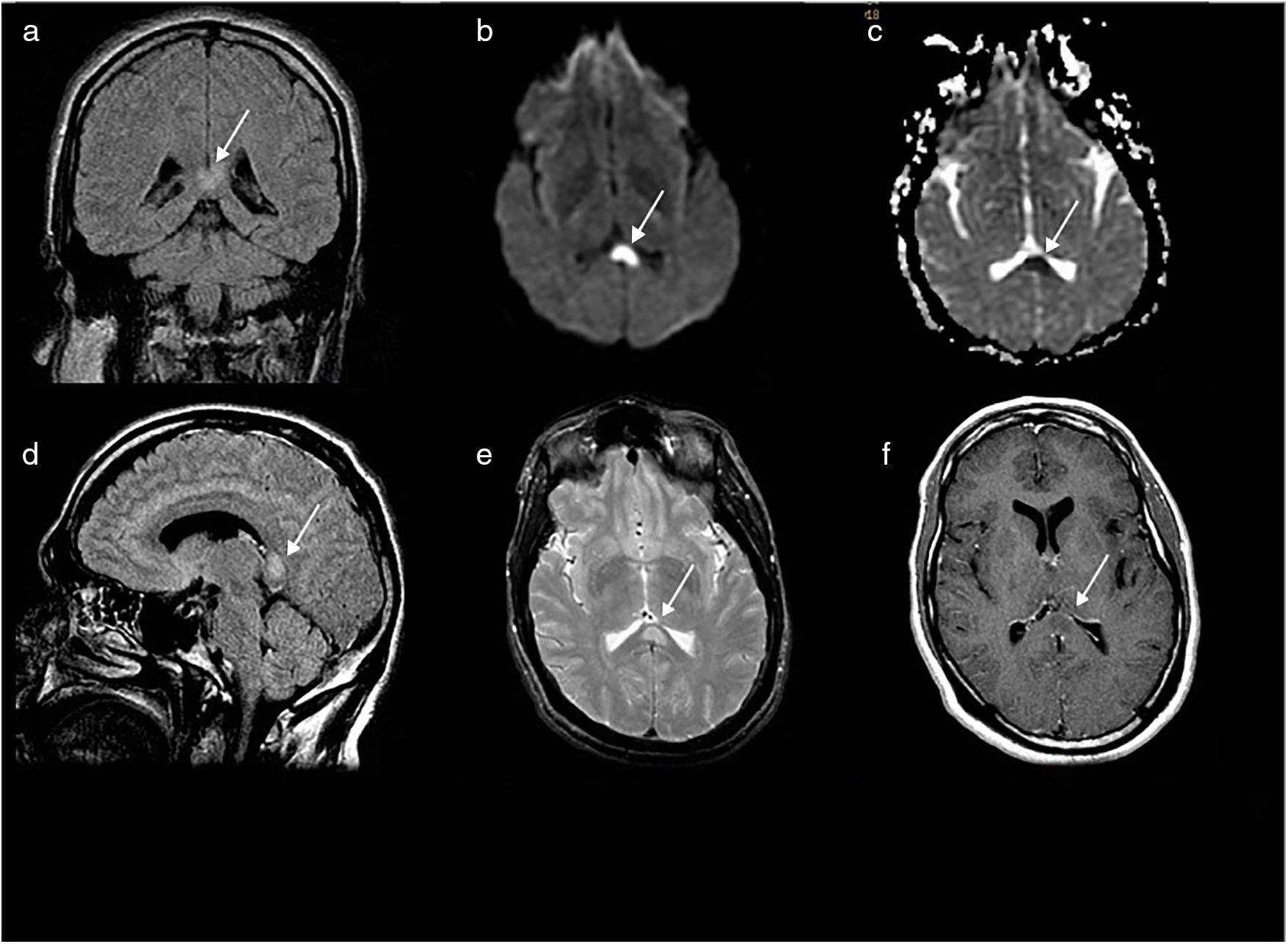 Mild encephalitis/encephalopathy with reversible splenial lesion: a ...