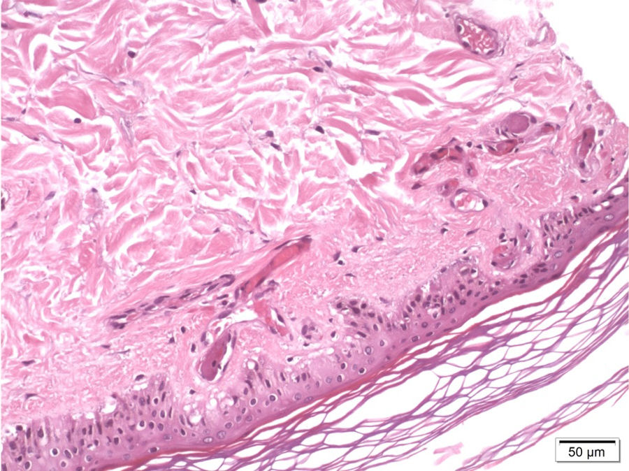 vasculitic mononeuritis multiplex