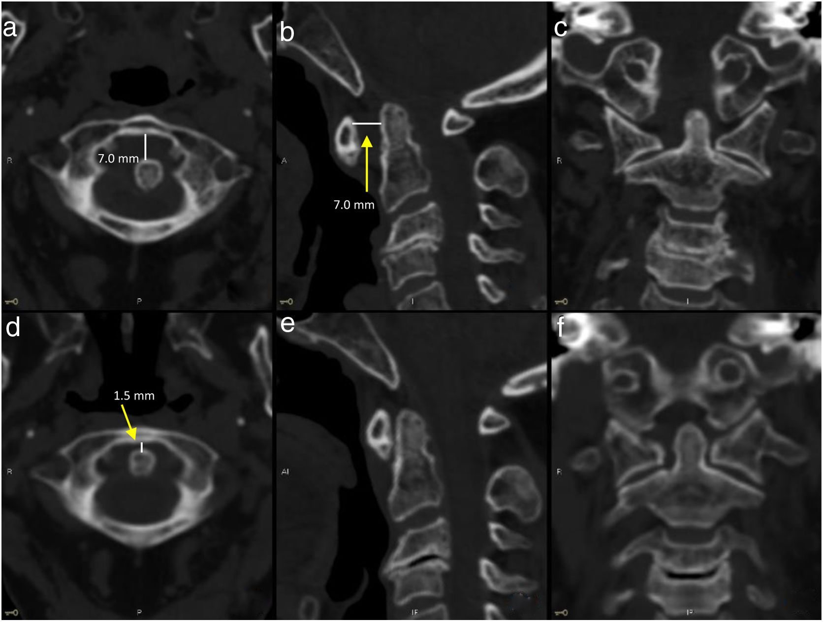 Acute lower limb paresis in a patient with rheumatoid arthritis ...