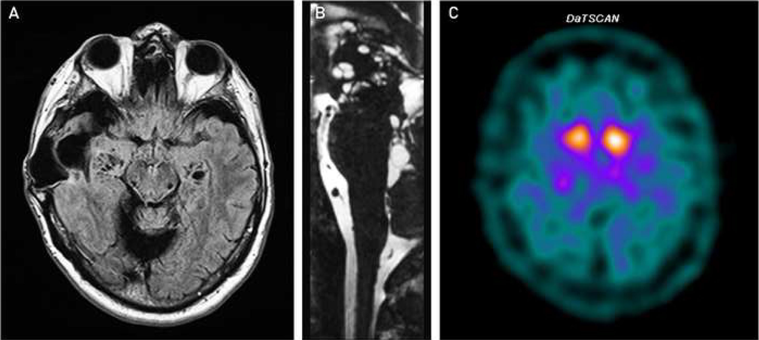 Midbrain Virchow-Robin spaces and Parkinsonism: A case report and ...