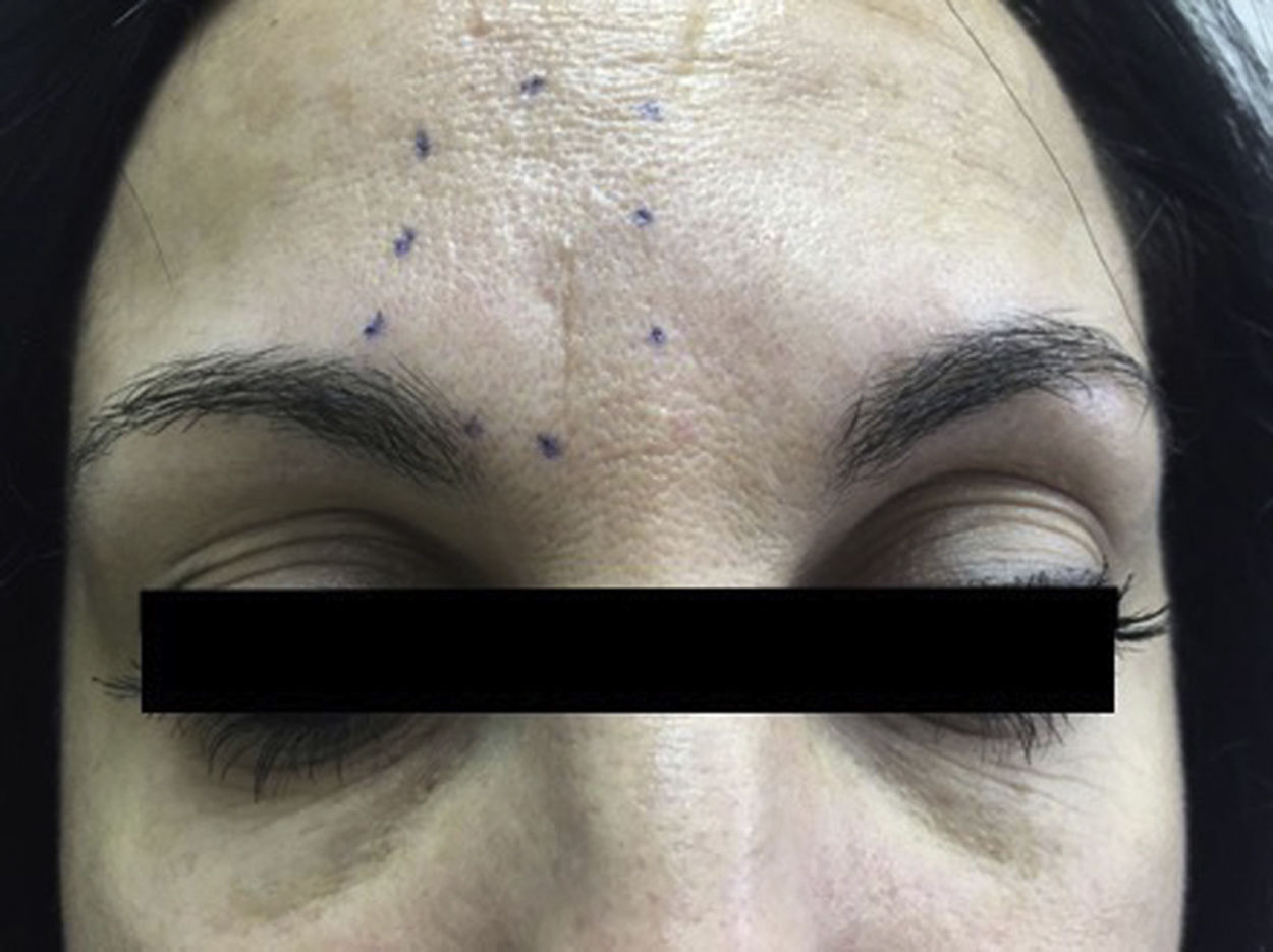 supratrochlear nerve block