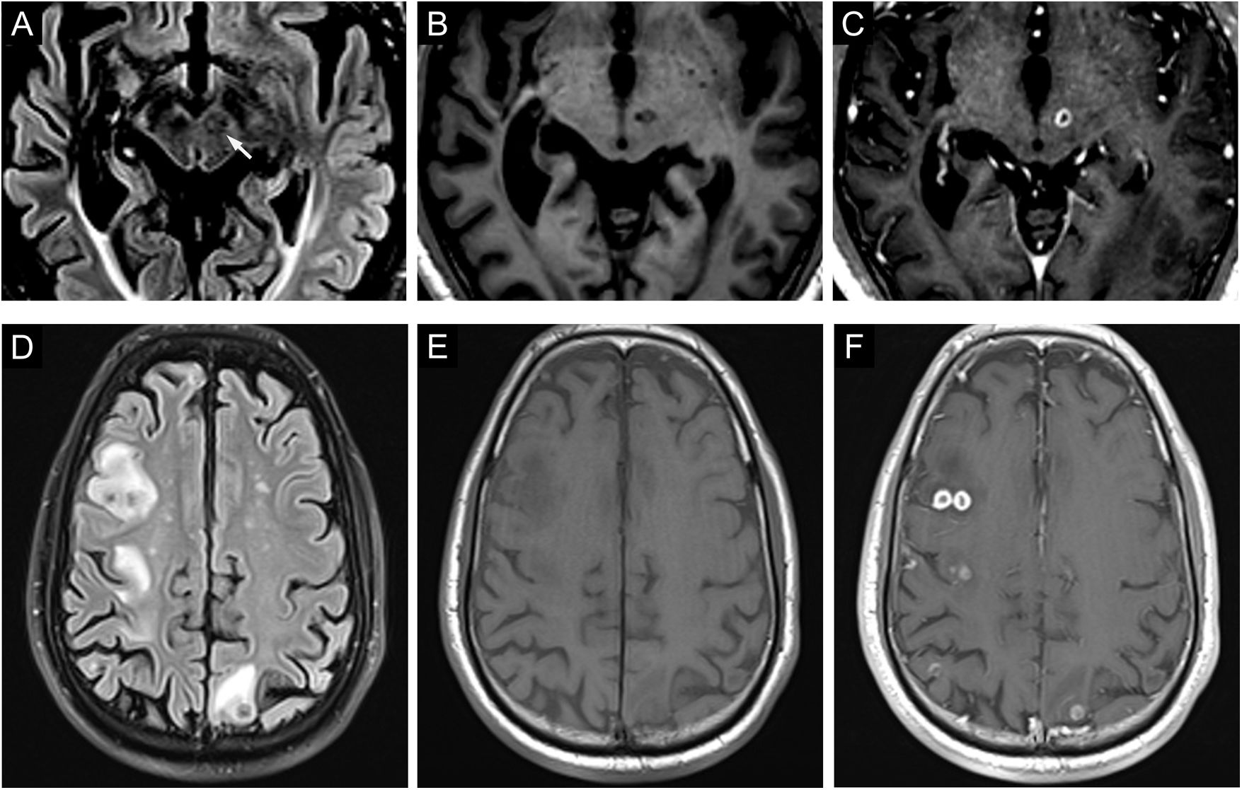 Dystonic head tremor secondary to neurocysticercosis | Neurología ...