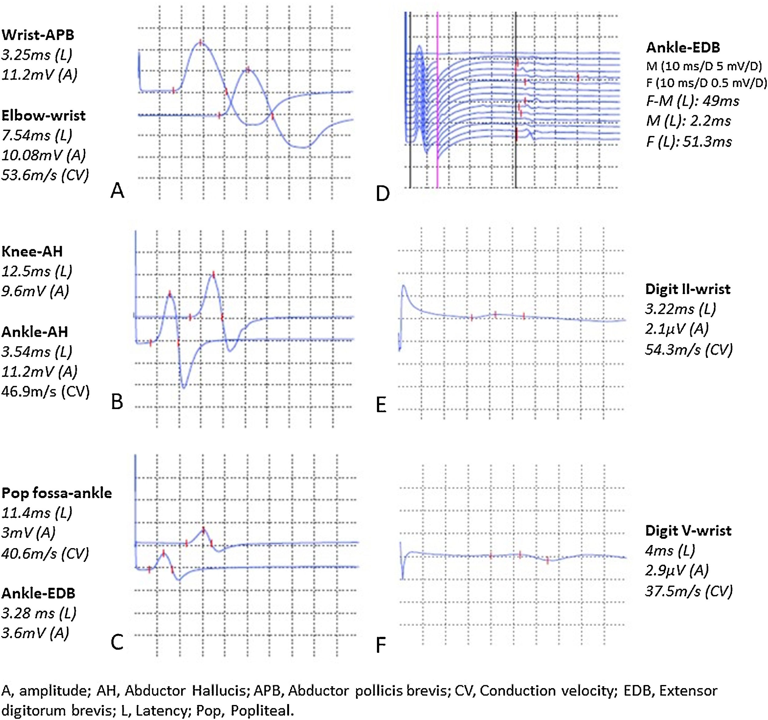 Acute inflammatory demyelinating polyneuropathy shortly after ...