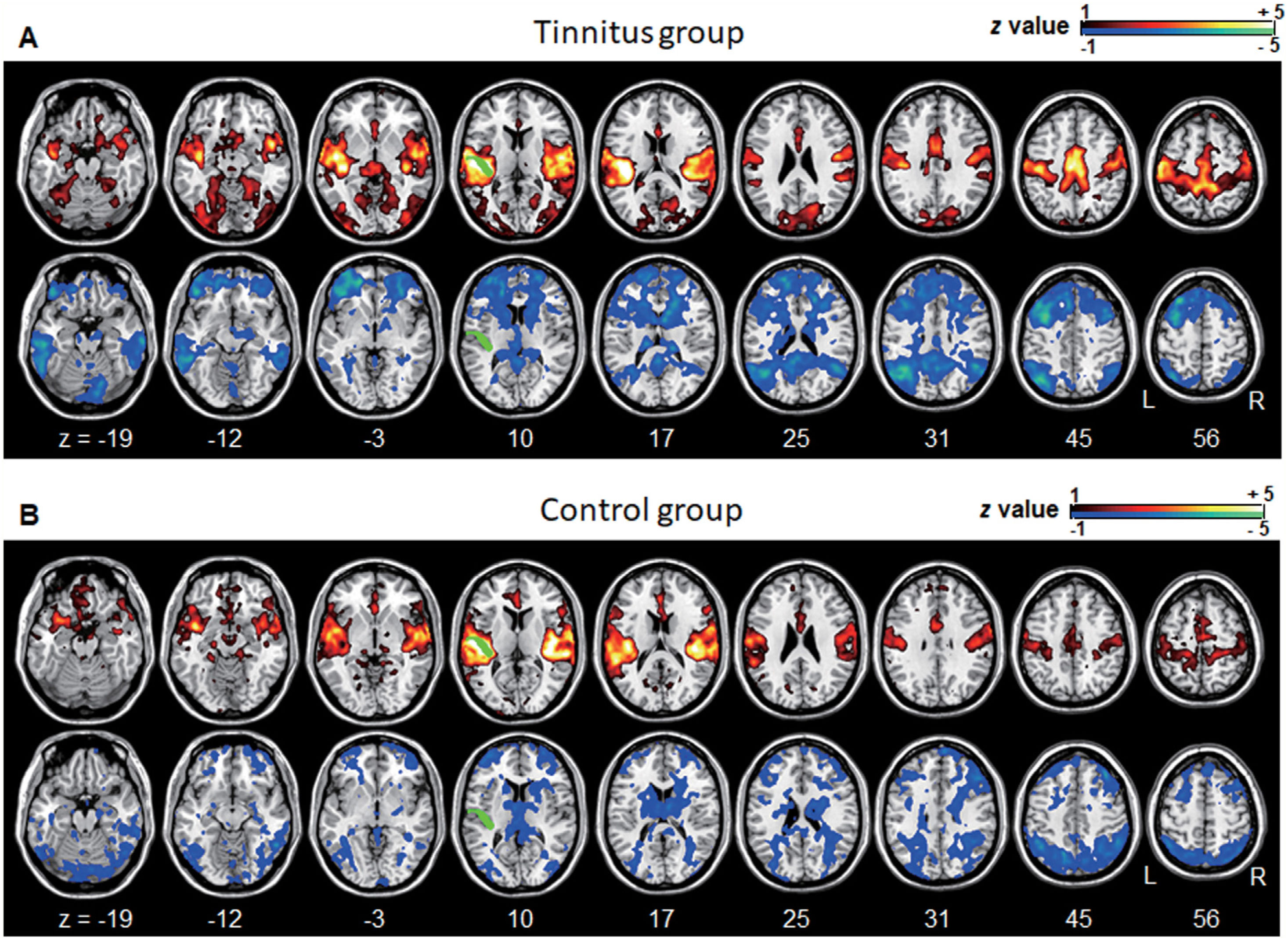 Auditory cortex hyperconnectivity before rTMS is correlated with ...