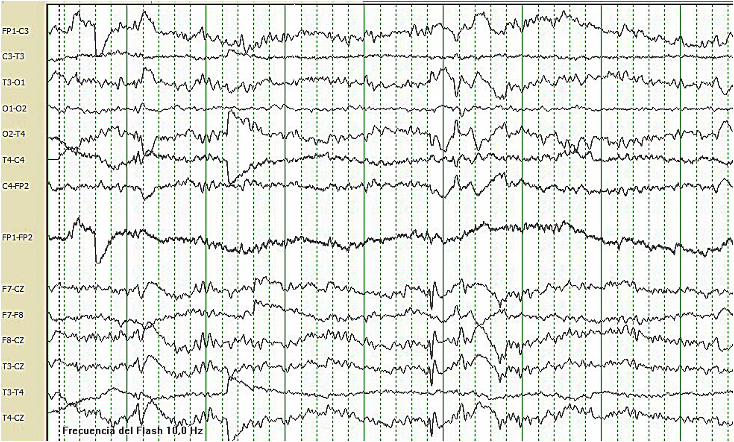 Epileptic and neurodevelopmental encephalopathy associated to SYNGAP1 ...