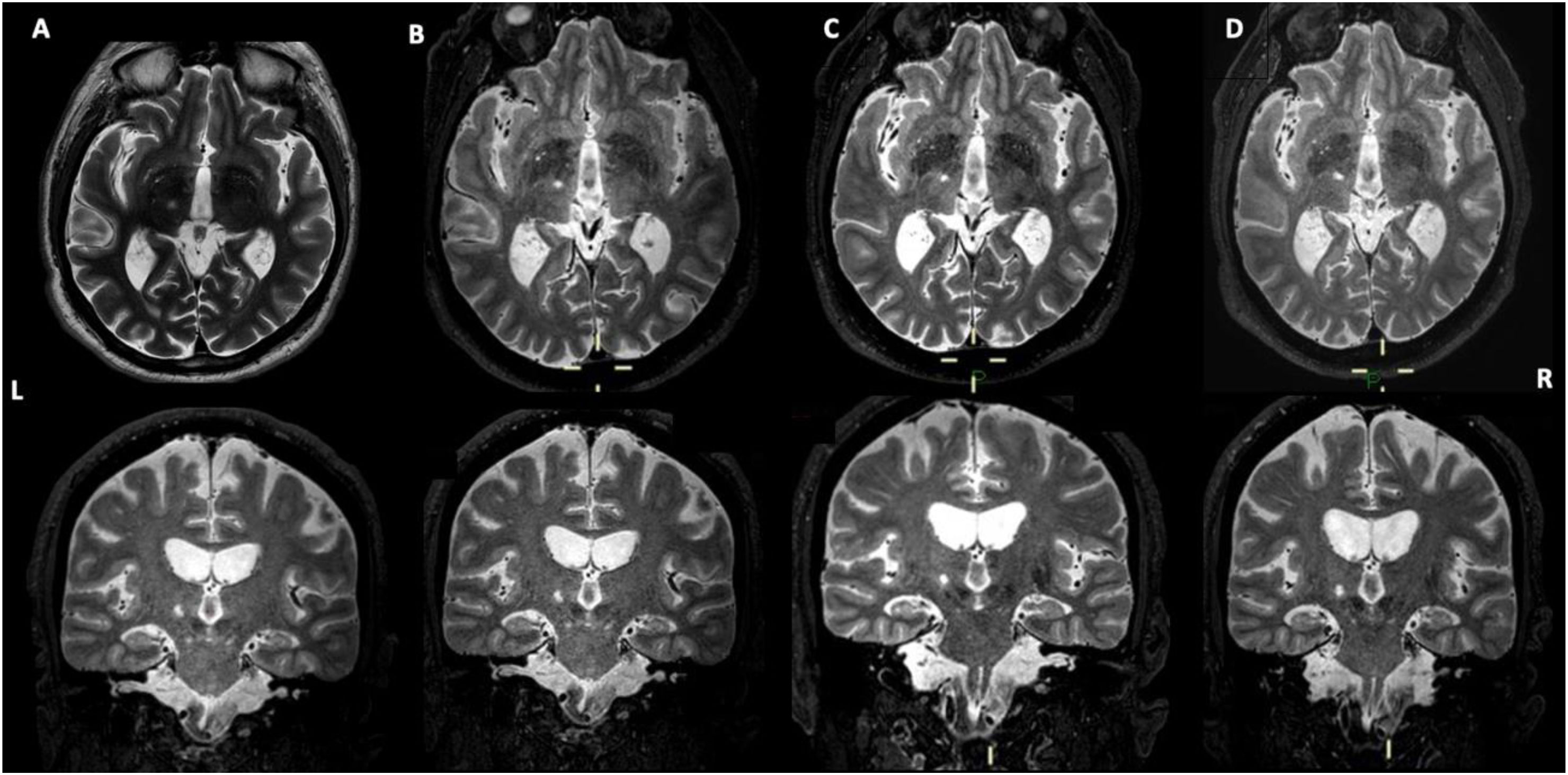 Unilateral MRIgFUS thalamotomy: Long-term follow-up in fragile X ...