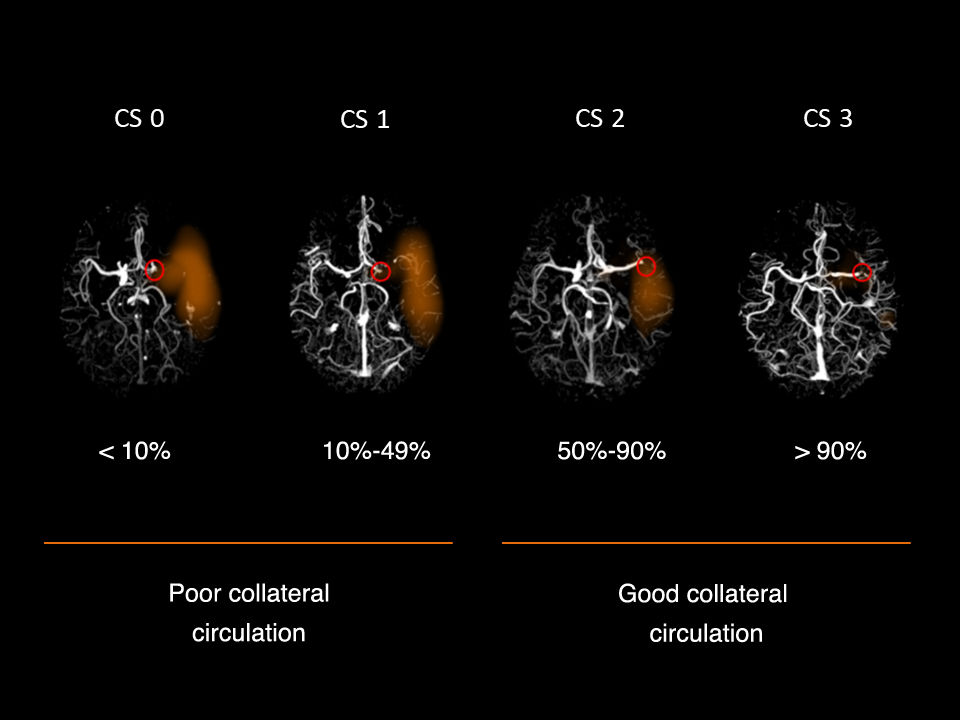 Influence of dehydration on collateral circulation and clinical outcome ...