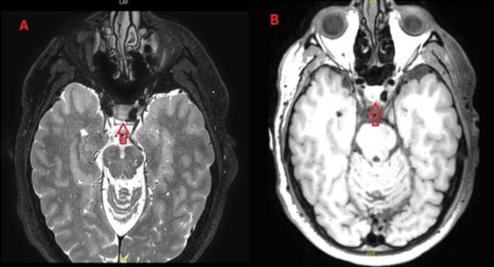 Fourth cranial nerve neuropathy due to Ecchordosis physaliphora ...