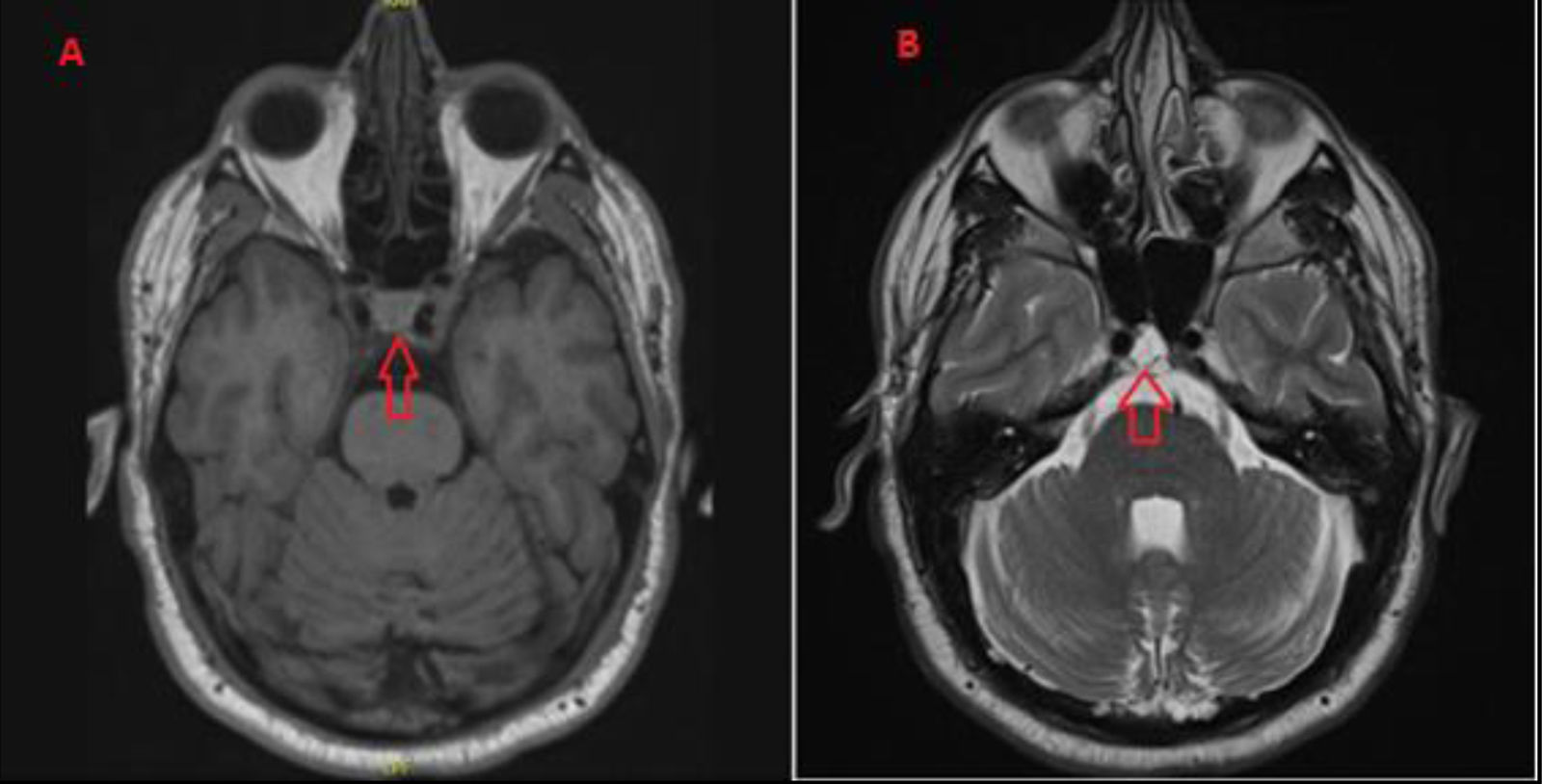 Fourth cranial nerve neuropathy due to Ecchordosis physaliphora ...