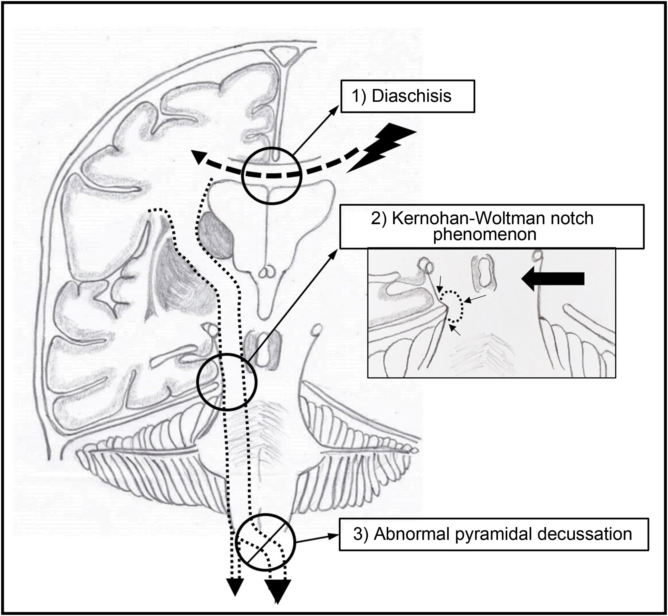 Kernohan-Woltman notch phenomenon: an exceptional neurological picture? | Neurología (English ...