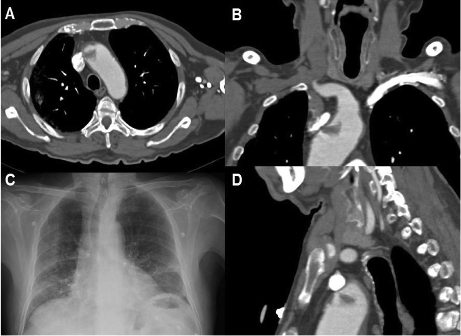 High frequency of endoluminal thrombus in patients with ischaemic ...