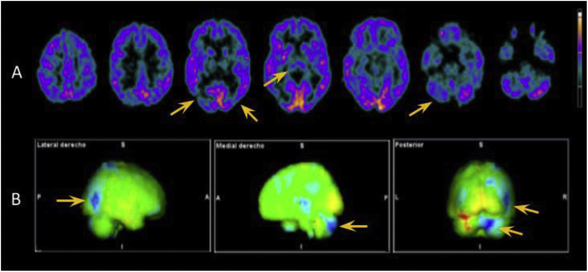 Sporadic fatal insomnia: a rapidly progressive phenotype resembling ...