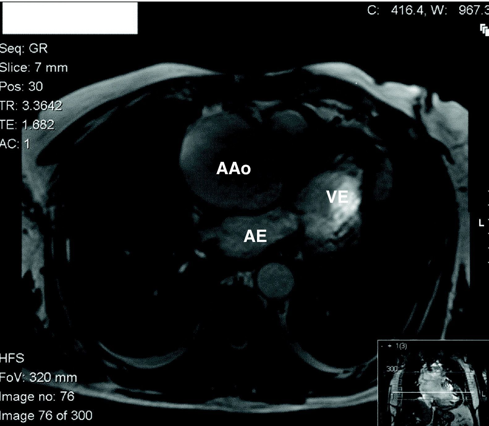 Annulo-aortic ectasia imaging | Revista Portuguesa de Cardiologia