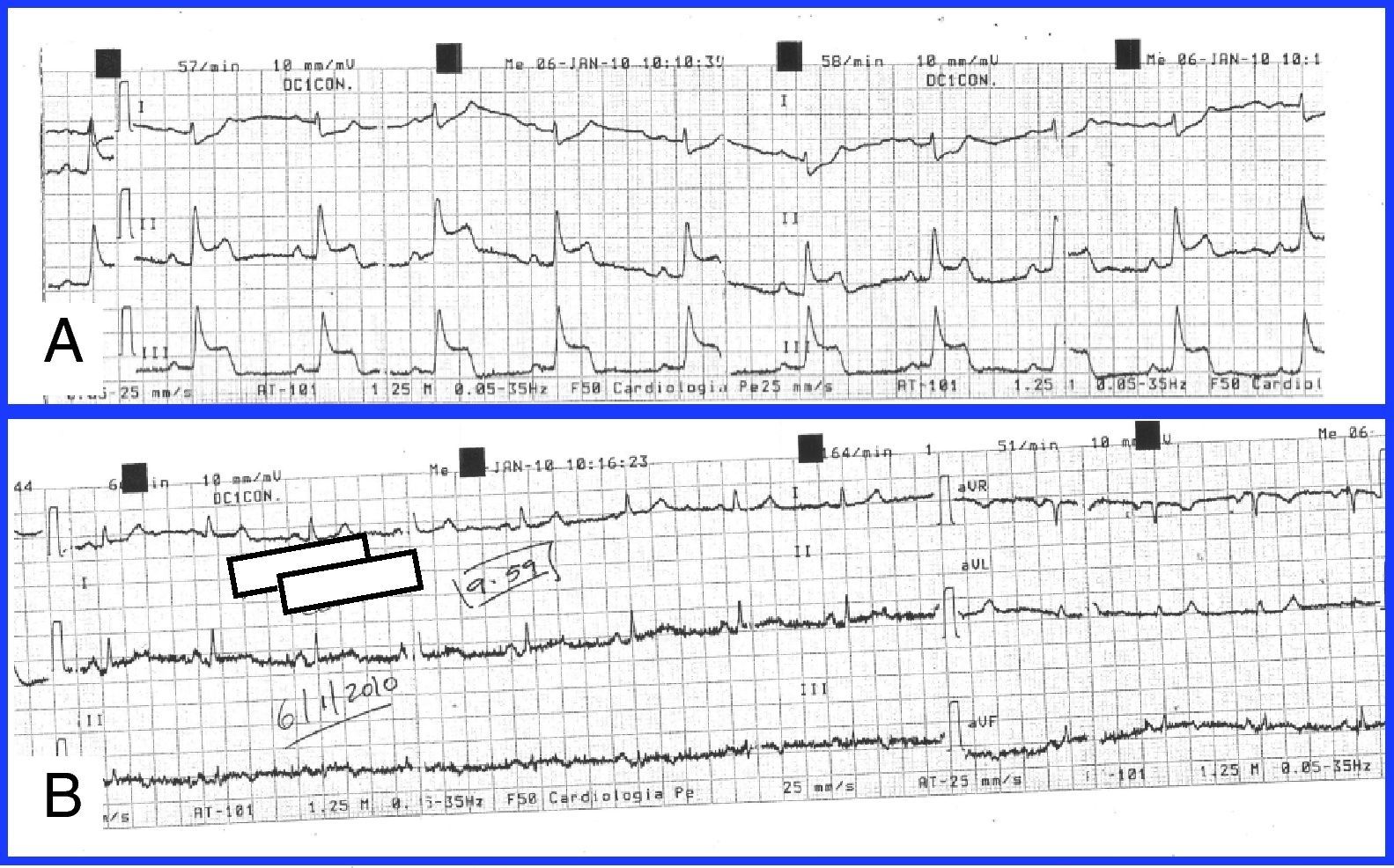 High-degree atrioventricular block induced by Prinzmetal angina ...