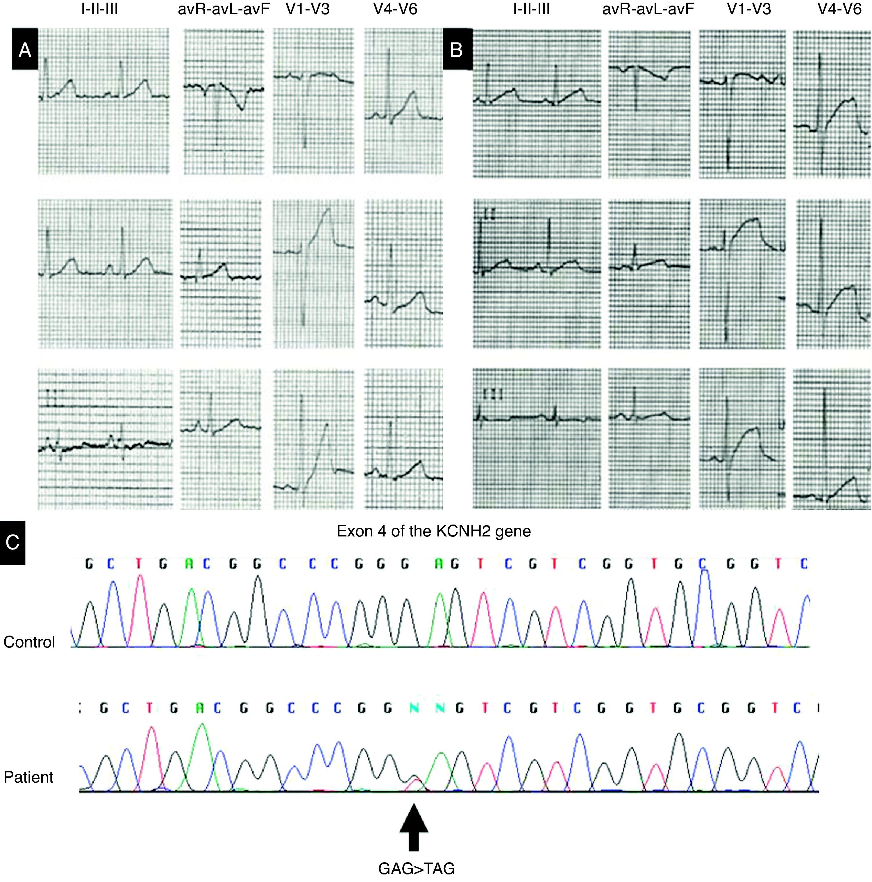Novel mutation in the KCNH2 gene associated with long QT syndrome ...