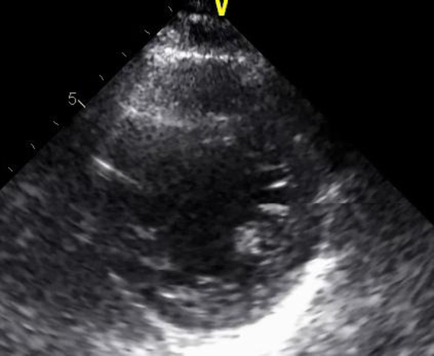 Left bundle branch block, atrioventricular block, torsade de pointes ...