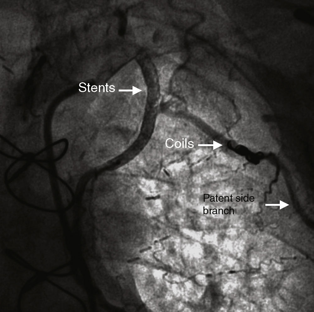 Ischemia induced by coronary steal through a patent mammary artery side ...