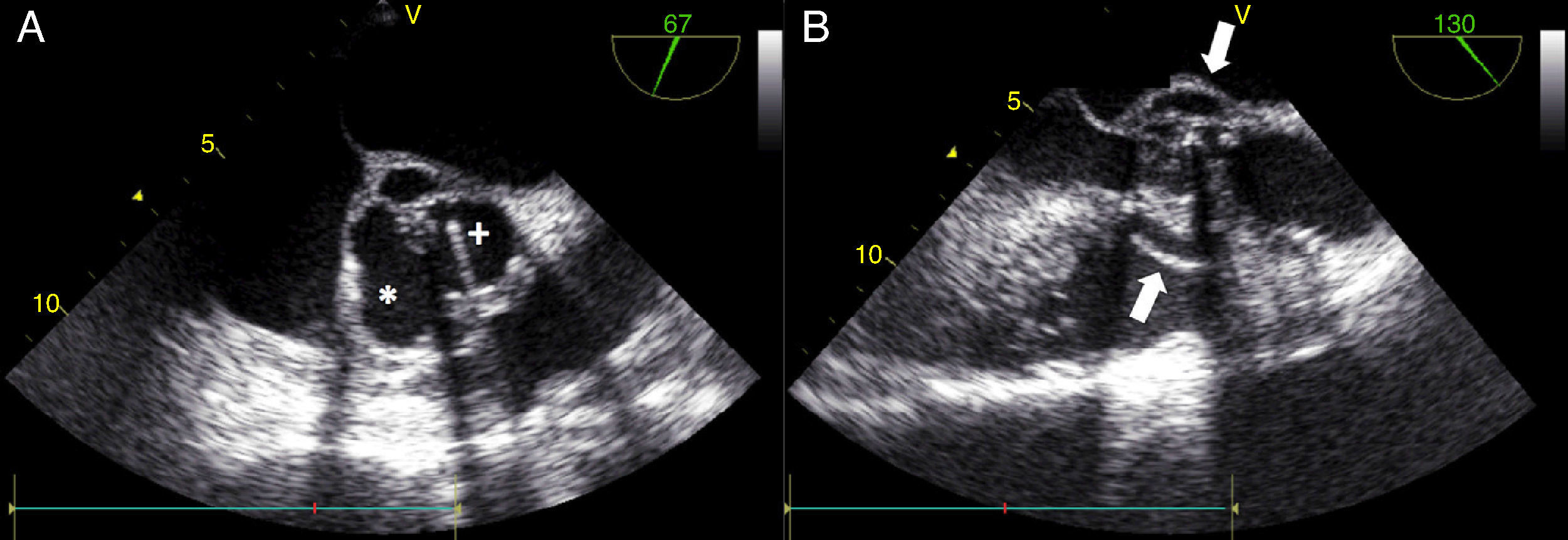 aortic valve echo view
