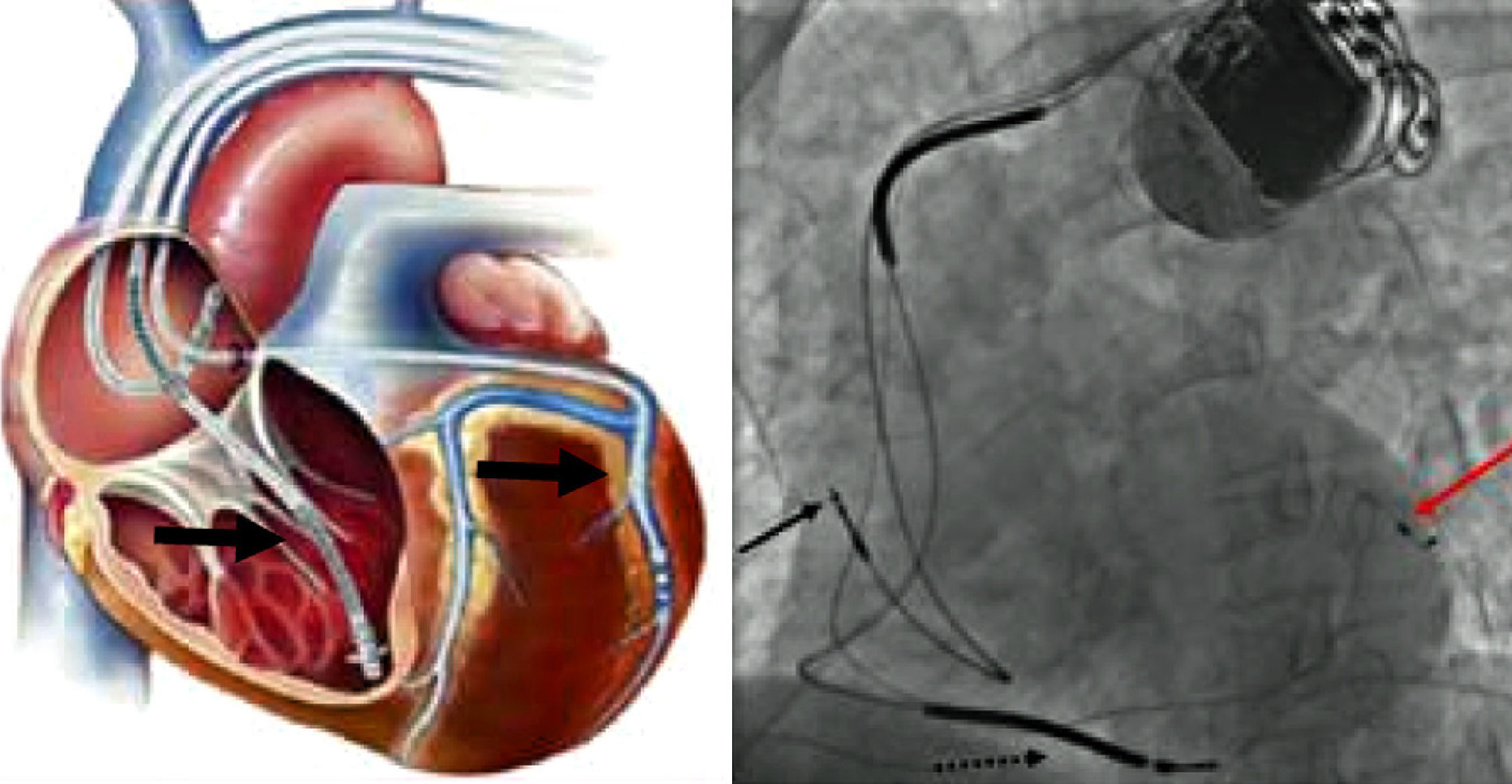 cardiac resynchronisation therapy