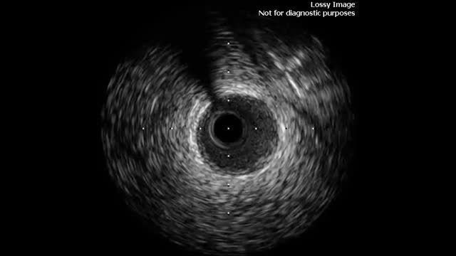 Coronary artery perforation: Don’t rush, IVUS may be useful | Revista ...