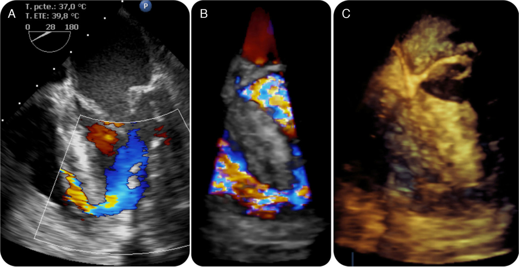 Ventricular septal rupture in a case of myocardial infarction with ...