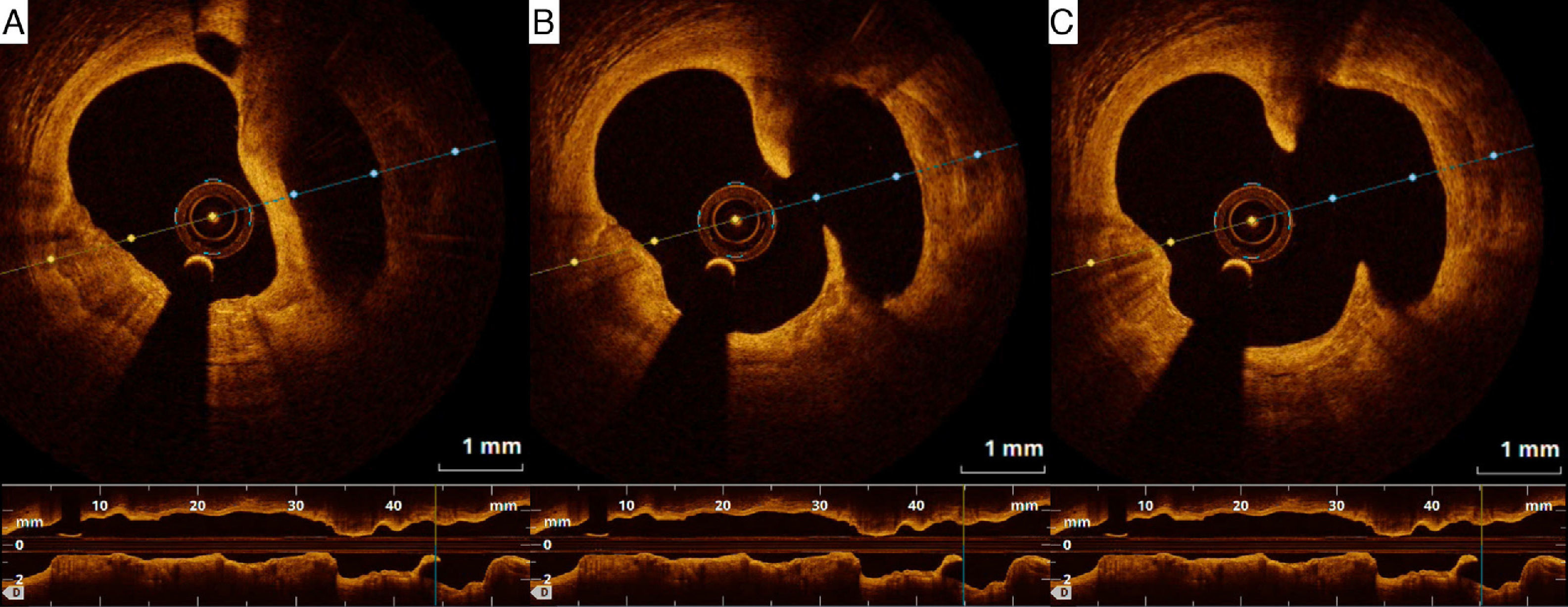 Coronary optical coherence tomography: A practical overview of current ...